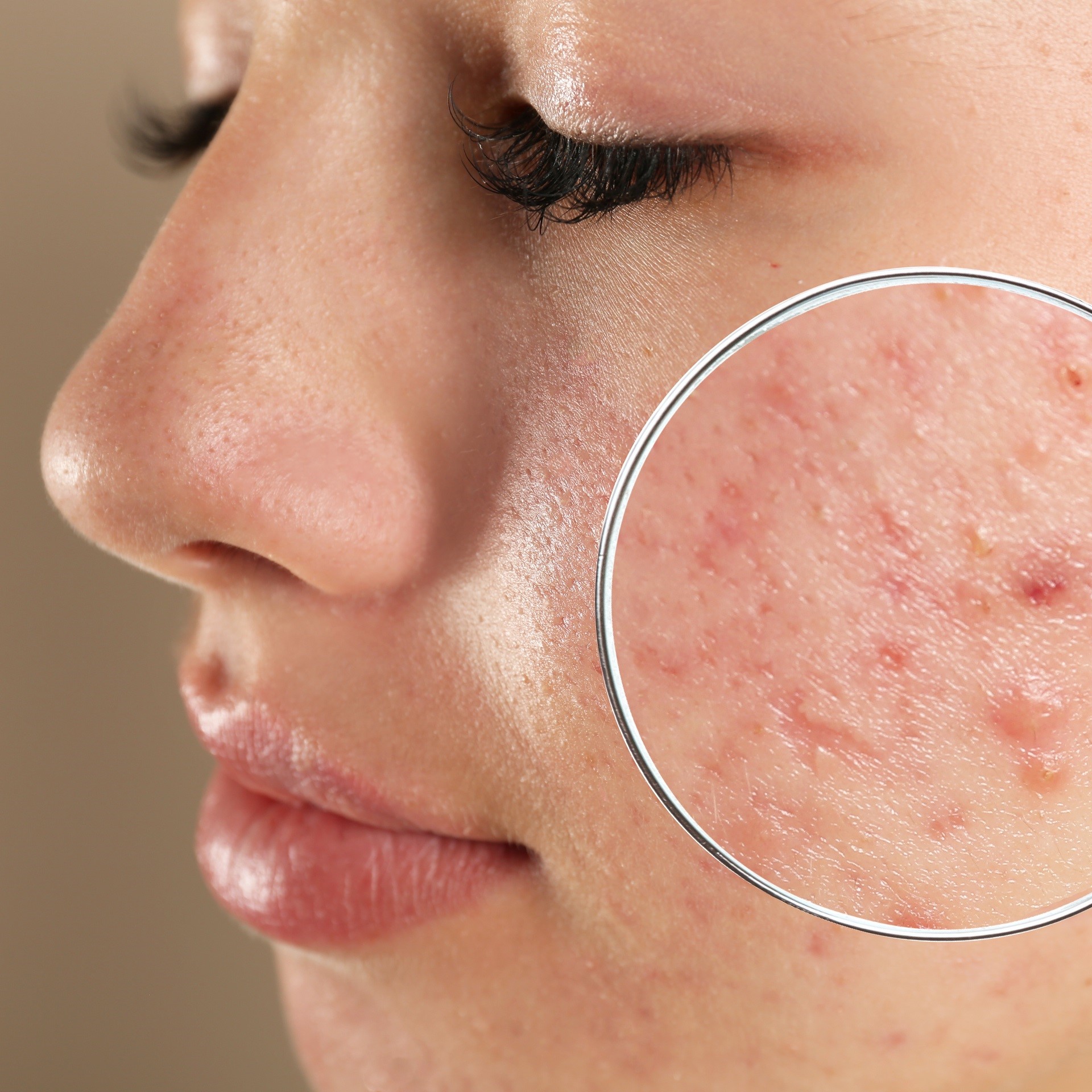 Tiny nanocarriers could prove the magic bullet for acne sufferers ...